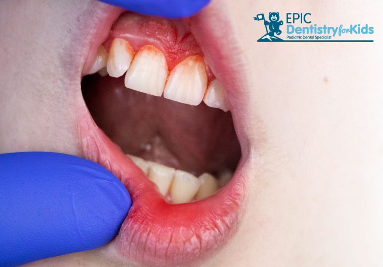 What Is the Best Way to Treat Toddlers’ Bleeding Gums? - EPIC Dentistry